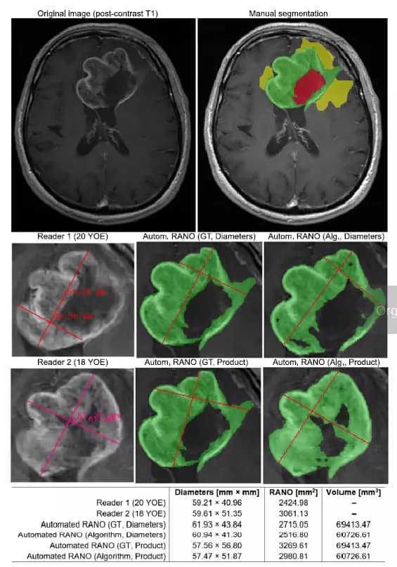 Automated RANO solution for clinical trial