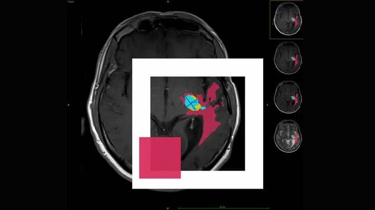 Biotechx Our Brain Tumor Segmentation Algorithm Graylight Imaging