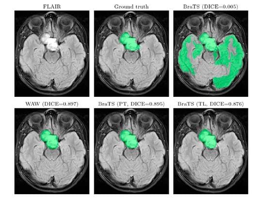 Segmenting pediatric optic pathway glioma from MRI using deep learning - Graylight Imaging