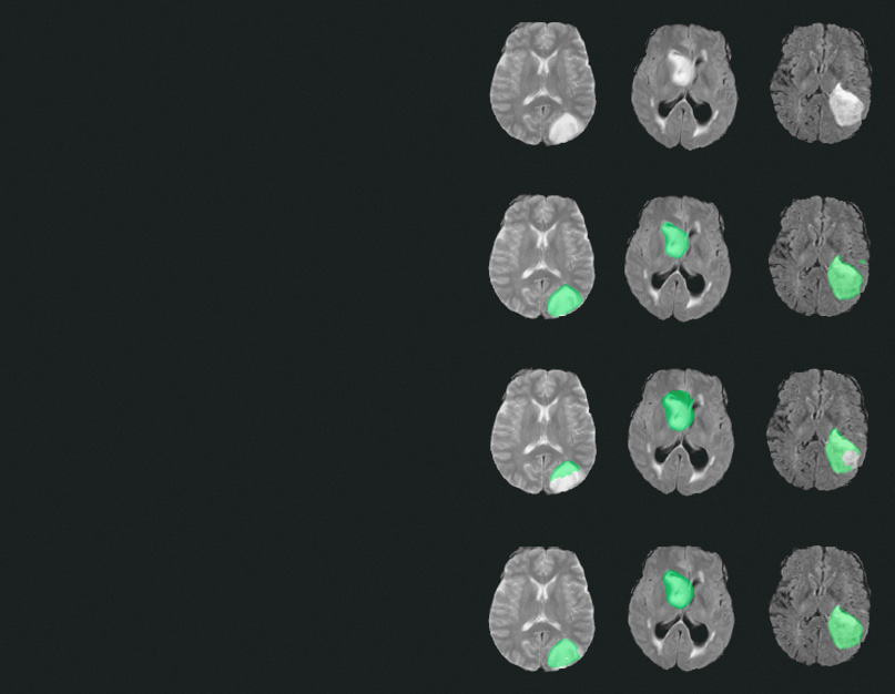 Segmenting pediatric optic pathway glioma from MRI using deep learning ...